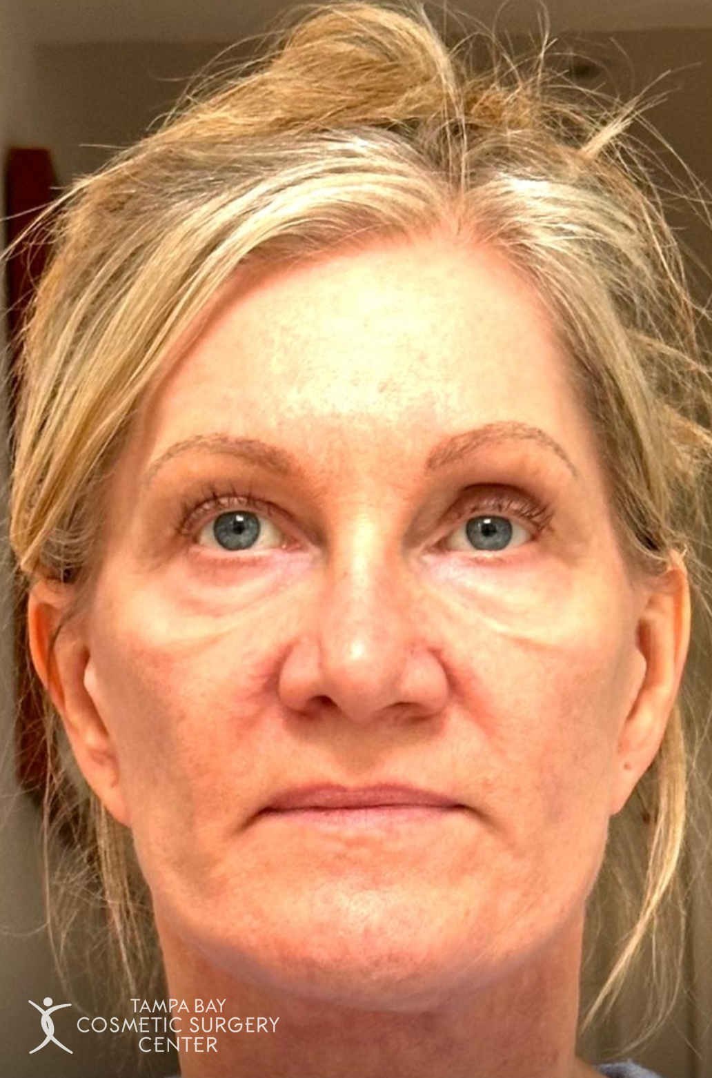 Festoons | Cosmetic Surgery Gallery